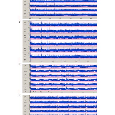 Abnormal AEEG Manifestations Of Neonatal HFMD Complicated With Download Scientific Diagram