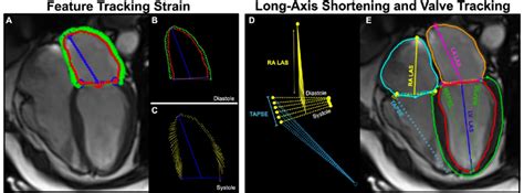 mono and bi planar atrial analysis methods feature tracking ft