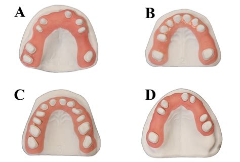 Color Photos Of The 3d Printed Models With Teeth Abutment And Gingiva Download Scientific