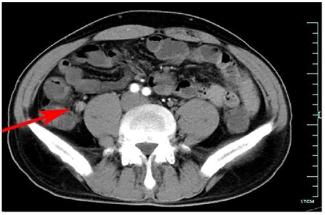 Frontiers Endoscopic Retrograde Appendicitis Therapy In The