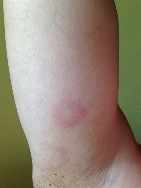 Появились красные пятна Вопрос дерматологу 03 Онлайн