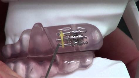 Somnomed Oral Appliance