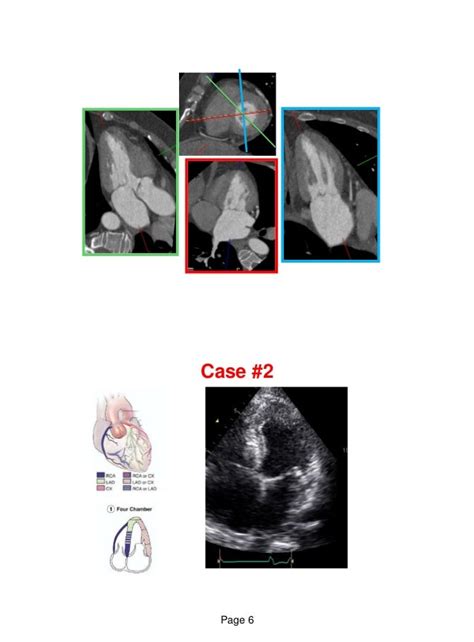 Echo In Ischaemic Heart Disease And Myocardial Infarction