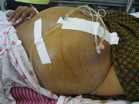 25 Facts About Cirrhosis