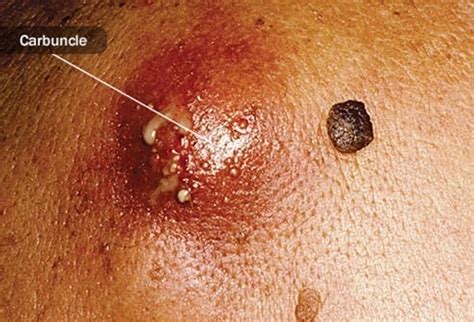 Pictures Of Skin Infections