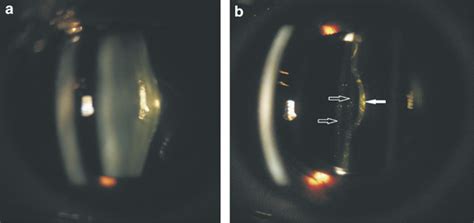 Slit Lamp Photo Of The Patient With Slit Illumination Showing The