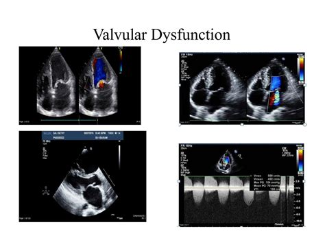 Basics Of Tte And Tee Trans Esophageal Echopptx