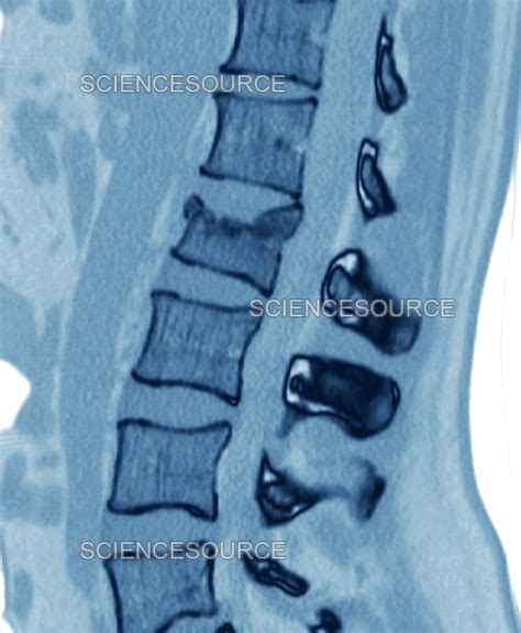 Fractured Spine Ct Scan Stock Image Science Source Images