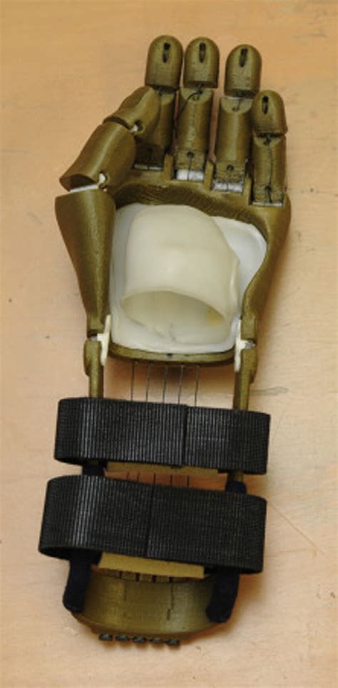 B Image Of 3d Printed Hand Prosthesis Permission Granted From Fig 5 Download Scientific