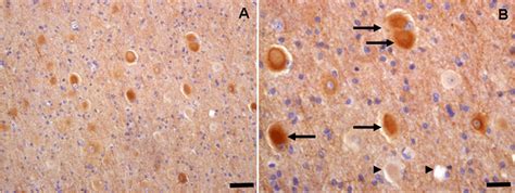 Neuronal Class Iii A Tubulin Tuj1 Immunostaining In Balloon Cells Download Scientific Diagram