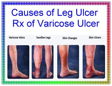 Causes Of Leg Ulcer Rx Of Varicose Ulcer Leg Ulcers Varicose Ulcer