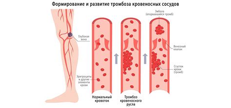 Лечение венозного тромбоза нижних конечностей в Киеве и Харькове | МЦ ...