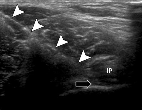 Us Guided Musculoskeletal Interventions In The Hip With Mri And Us