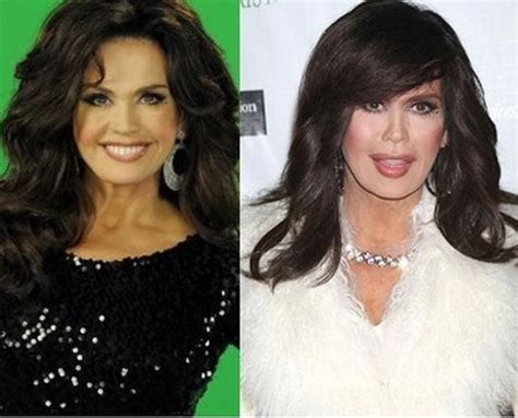 Celebrity Marie Osmond Before And After Plastic Surgery
