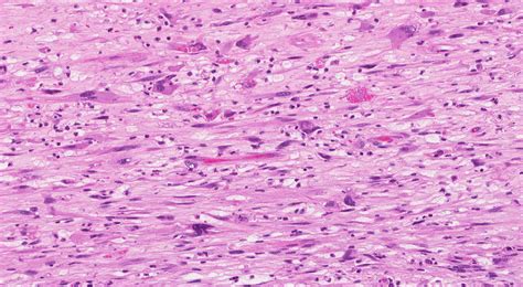 Czym Jest Złośliwy Nowotwór Wrzecionowatokomórkowy Mypathologyreport