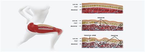 Fascia Blasting For Tension Relief Circulation And Wellness City Sweats