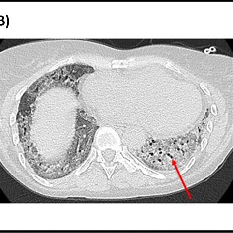 Representative Axial Ct Scan Slices Of A Patient With Baseline Ssc Ild