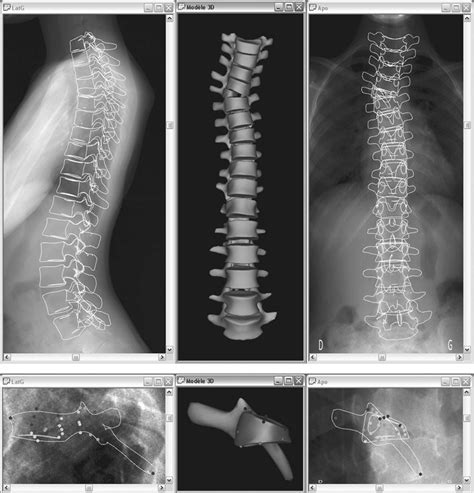 3d Reconstruction From Biplanar Radiography And Model Projection On The