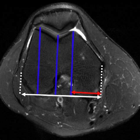 To Assess The Role Of The Trochlear Position On The Femur The Deepest