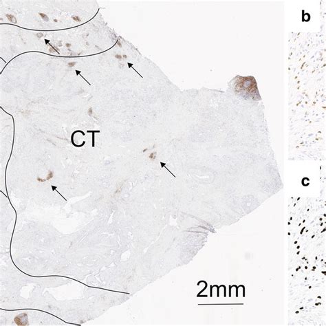 T Cell Infiltration In Different Regions Of Pancreatic Ductal