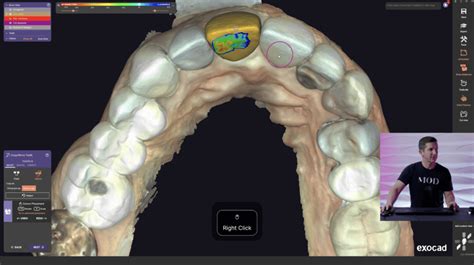 Exocad Level Foundations The MOD Institute