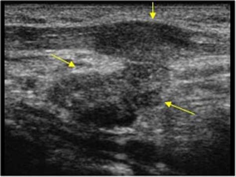Head And Neck 41 Thyroid Gland Case 413 Thyroid Malignant