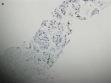 Liver Metastases From Prostate Cancer Abdominal Key