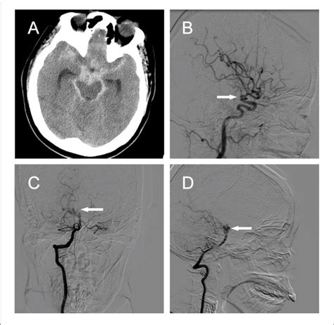 Case 2 A Head Ct Revealing Sah In The Suprasellar Cistern Ambient