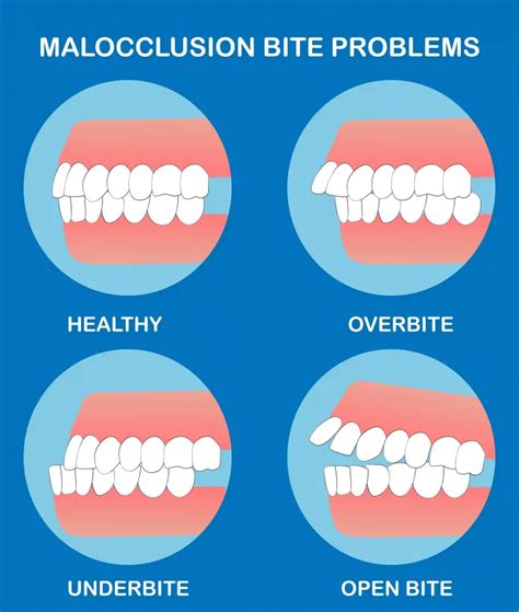 What Is Malocclusion Causes Effects And Treatment Options