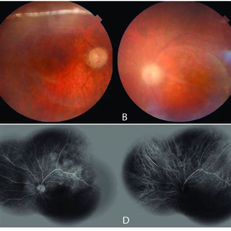 B Scan Structural Optical Coherence Tomography Showing Diffuse Atrophy