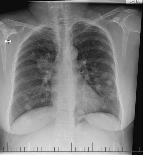 Forty Two Year Old Woman With Incidental Bilateral Nodular Opacities On