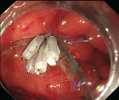Endoscopic Full Thickness Resection Of A Gastric Gist A A Gastric