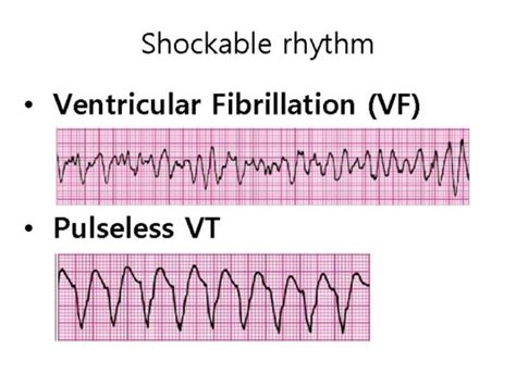 Shockable Vs Non Shockable Rhythms Aed Use Explained