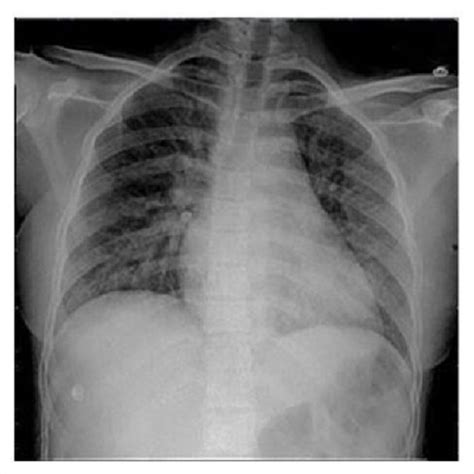 Cxr Showing Increased Left Lower Zone And Retrocardiac Density Download Scientific Diagram