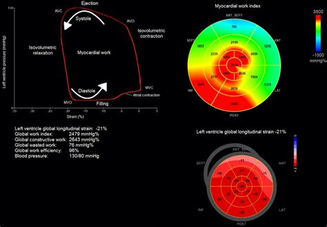 Myocardial Work Mw Was Calculated Using Echopac Version 204 Ge