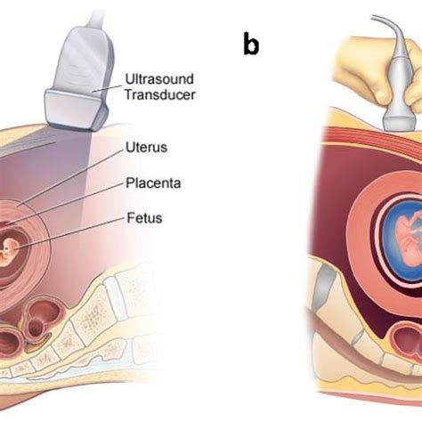 Transcervical A And Transabdominal B Chorionic Villi Sampling