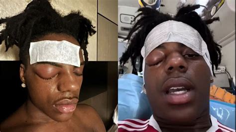 Ishowspeed Is Reportedly Undergoing Eye Surgery Related To Cluster