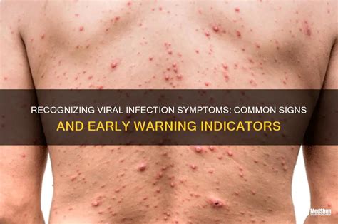 Recognizing Viral Infection Symptoms Common Signs And Early Warning Indicators Medshun