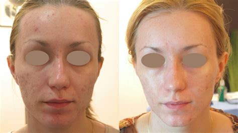 Peeling Facial Cu Laser Dr Dana Miricioiu