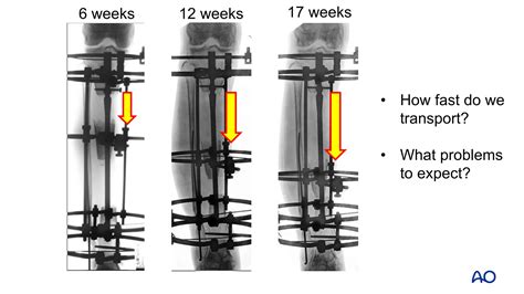 Tibia Defect Transportation Nail Oct52018 Pptx
