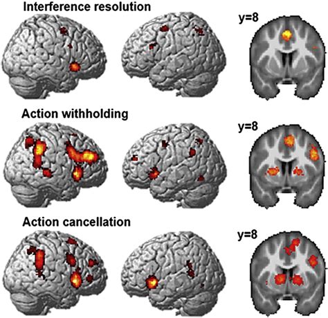 Meta Analysis Of The Neural Correlates Of Response Inhibition Brain Download Scientific Diagram