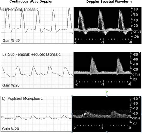 Arterial Waveform Ultrasound Diagnostic Medical Sonography Vascular