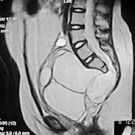 Multiloculated Cyst With Variable Epithelium Lining And Discontinuous