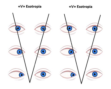 Premium Vector Types Of Strabismus V Esotropia And V Exotropia