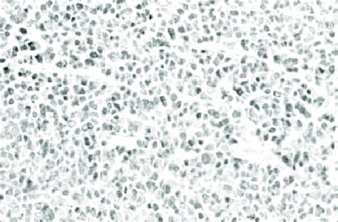 Cutaneous Neuroendocrine Carcinoma Showing Neuron Specific Enolase Download Scientific Diagram