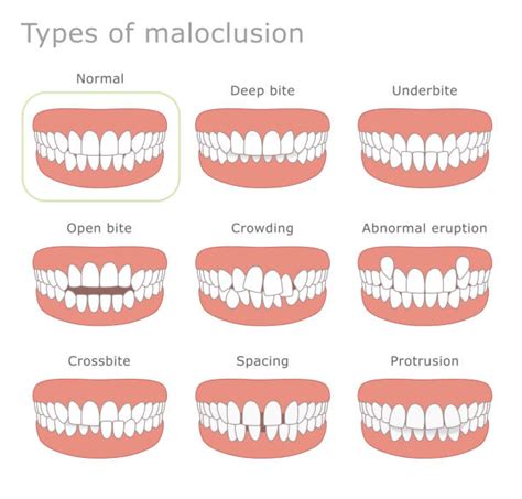 170 Malocclusion Stock Illustrations Royalty Free Vector Graphics And Clip Art Istock
