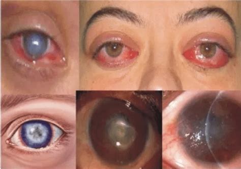 Corneal Diseases Dr Asif Khokhar