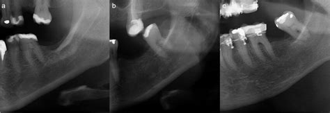 Figure Representing The Mandibular Cortical Index Evaluation A C1 — Download Scientific