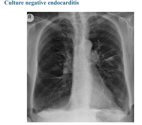 Culture Negative Endocarditis