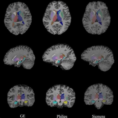Fsl First Segmentation Results Of Different Mri Acquisitions Download Scientific Diagram
